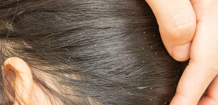 The Consequences of Leaving Dead Nits in Your Hair: How to Remove Nits ...